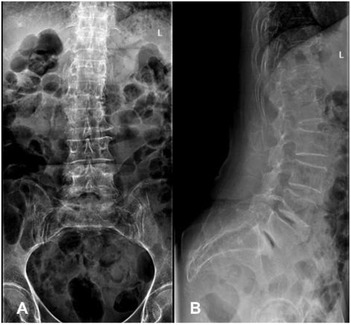 What is the Treatment for Vacuum Disc Phenomenon: Effective Solutions ...